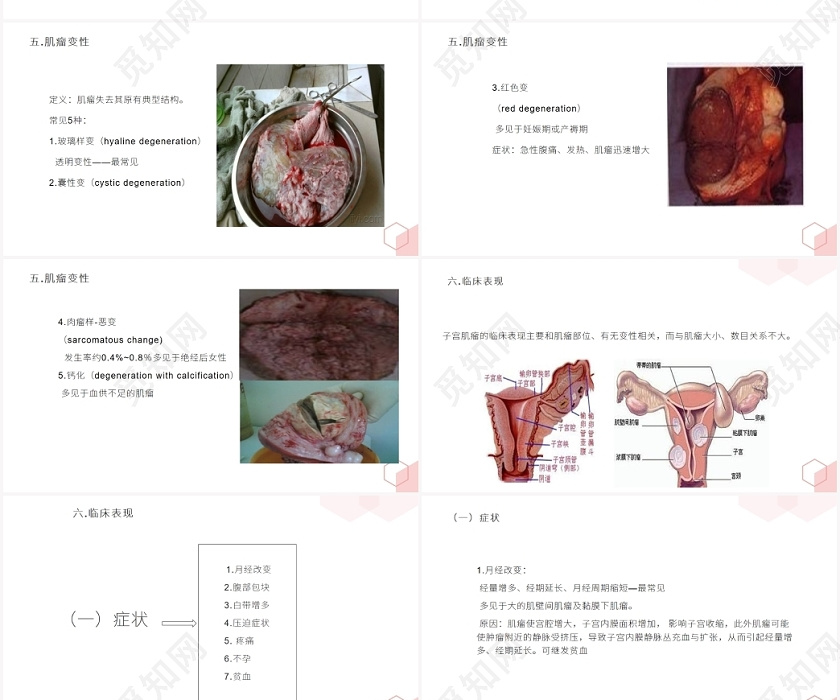 粉色卡通子宫肌瘤护理查房子宫肌瘤PPT模板下载 觅知网